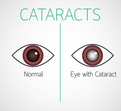 7 Causes of Low Vision - Better Vision Guide