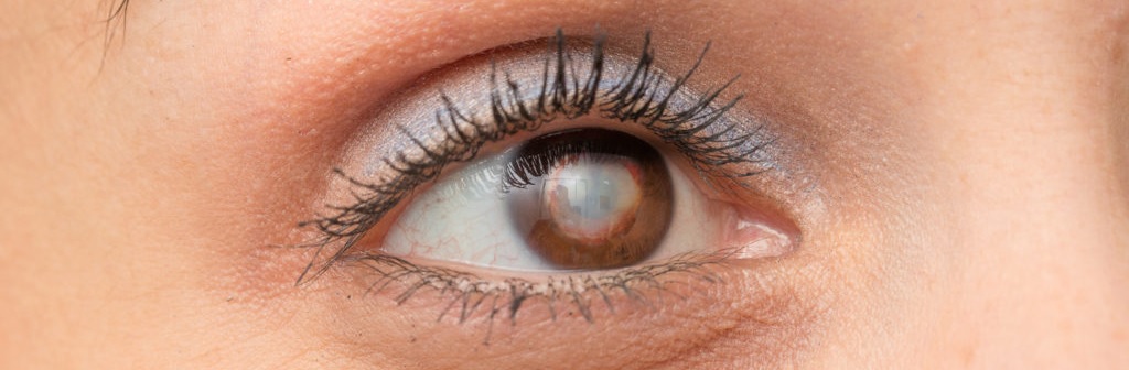 Posterior Capsule Opacity (PCO) | Cataract Surgery Complications